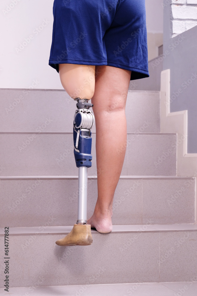 Foto de Disabled woman with prosthetic legs prosthetic leg concept. do ...