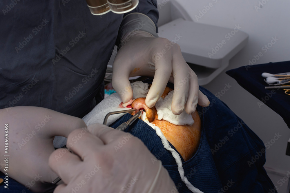 A cosmetic surgeon begins to make a deep incision on the columella of ...