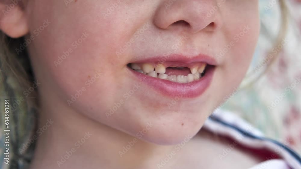 Child's mouth without the top two milk teeth in close-up. Toothless ...