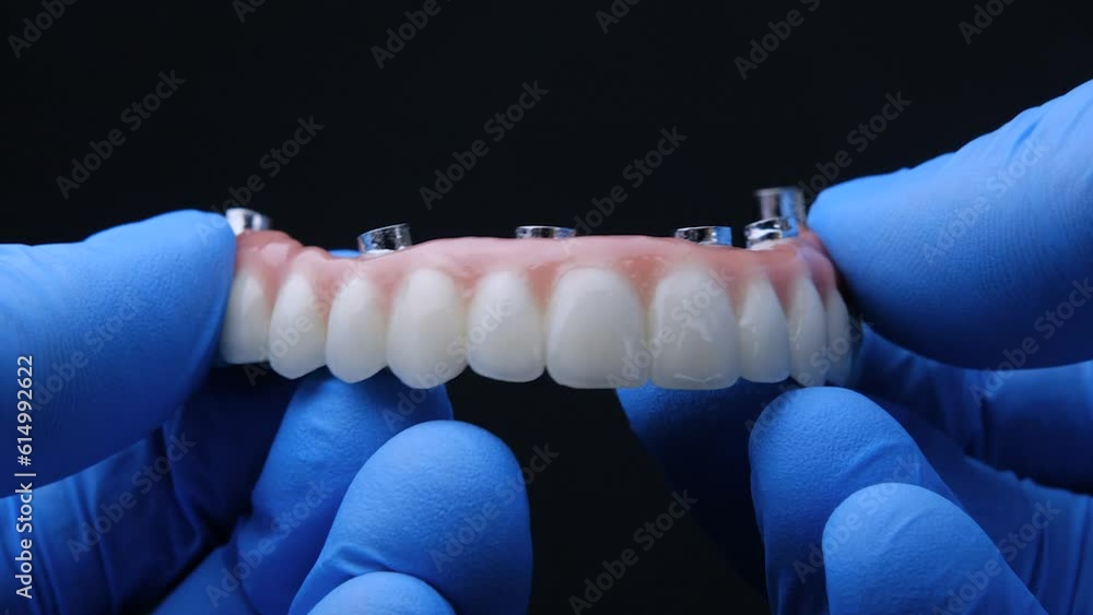 All-on-X Models: The Perfect Permanent Fixation Solution for Patients ...