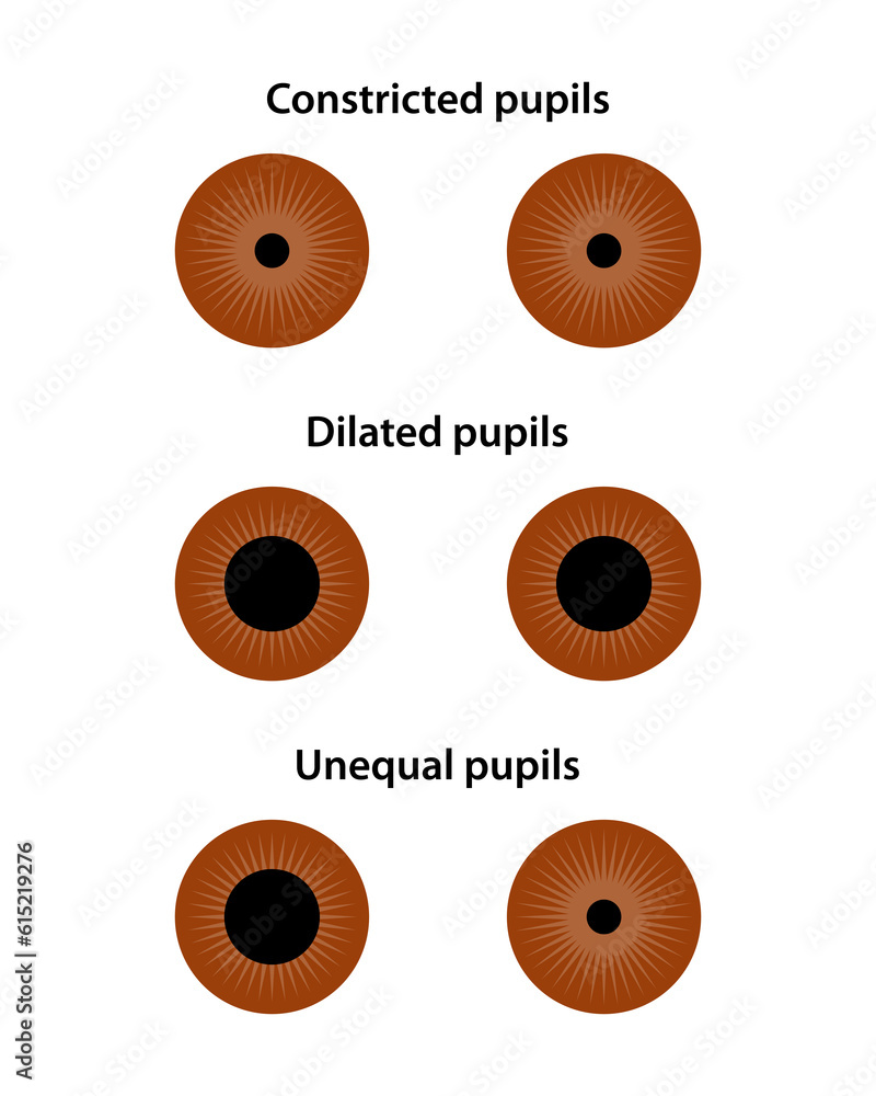 Human eye. Constricted, dilated, and unequal pupils. ilustração do ...
