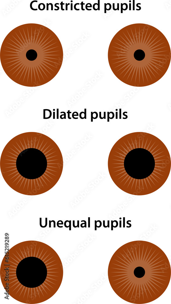 Human eye. Constricted, dilated, and unequal pupils. Stock Illustration ...