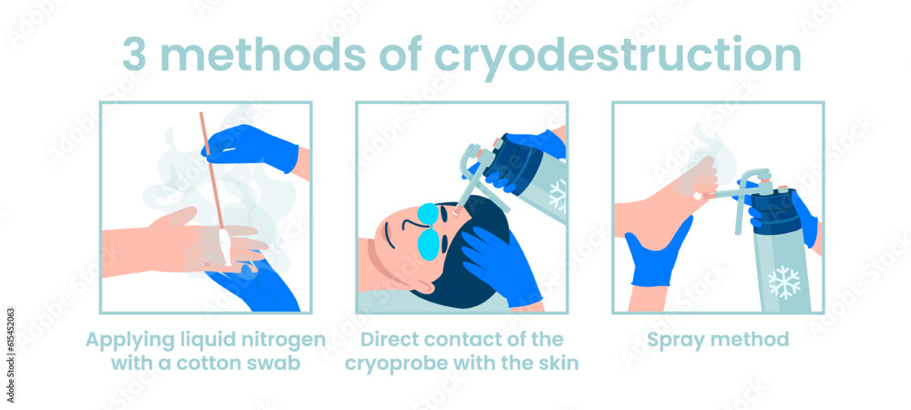 Methods of cryodestruction. Application of liquid nitrogen with a ...