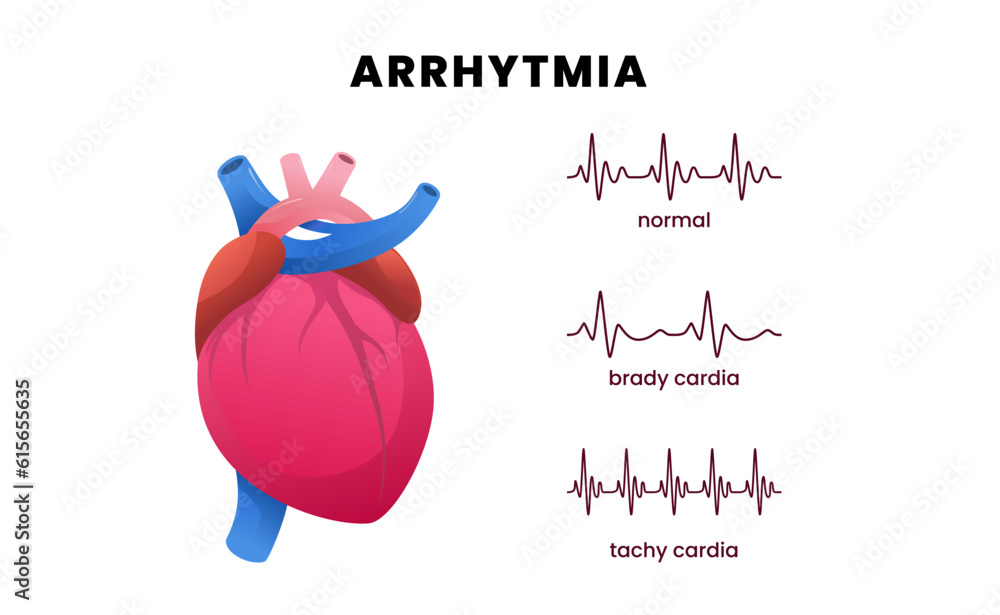 Cardiac disease arrhythmia with a heart and pulse ECG, showcasing ...