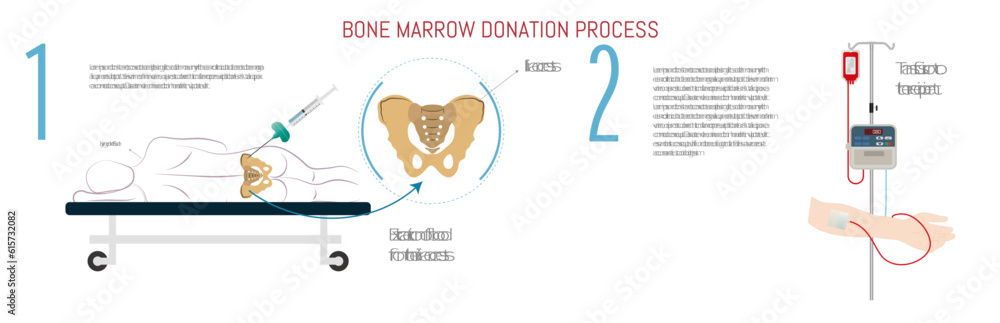 Process of bone marrow transplantation by means of an iliac crest ...