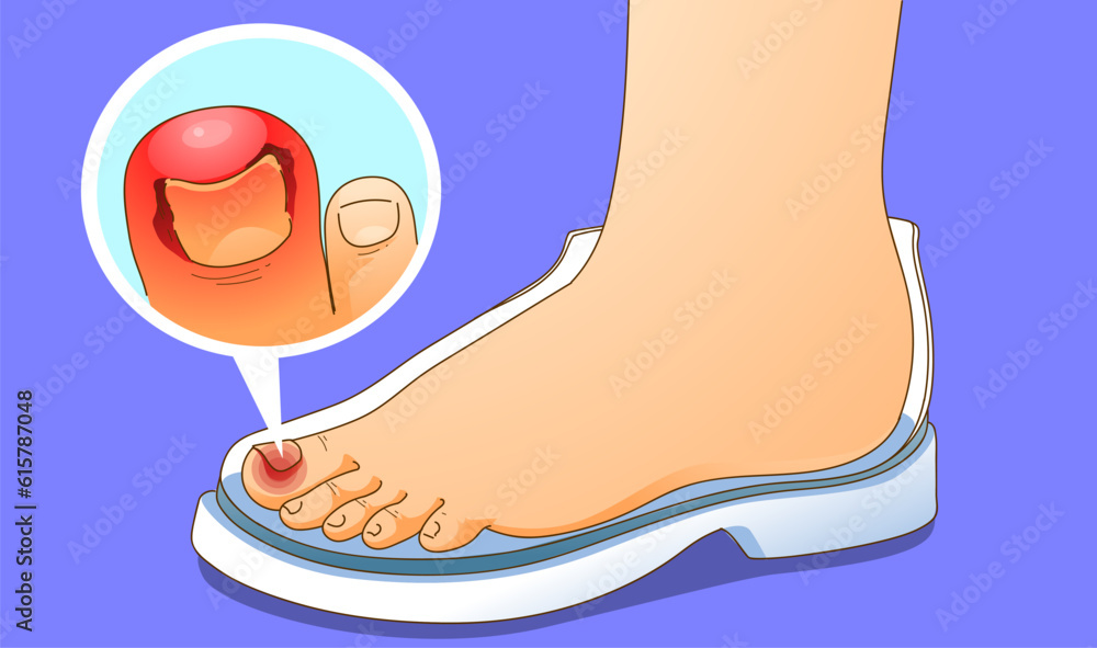 Fingers with ingrown toenail, vector illustration Stock Vector | Adobe ...