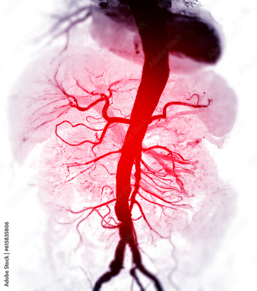 Cta Whole Aorta 3d Rendering Stock Illustration Adobe Stock