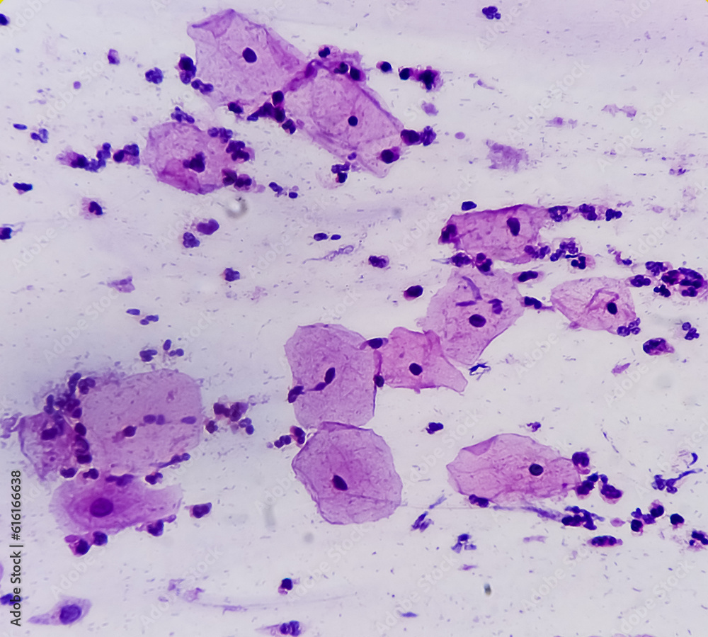 Pap's smear. Inflammatory smear with HPV related changes. Cervical ...