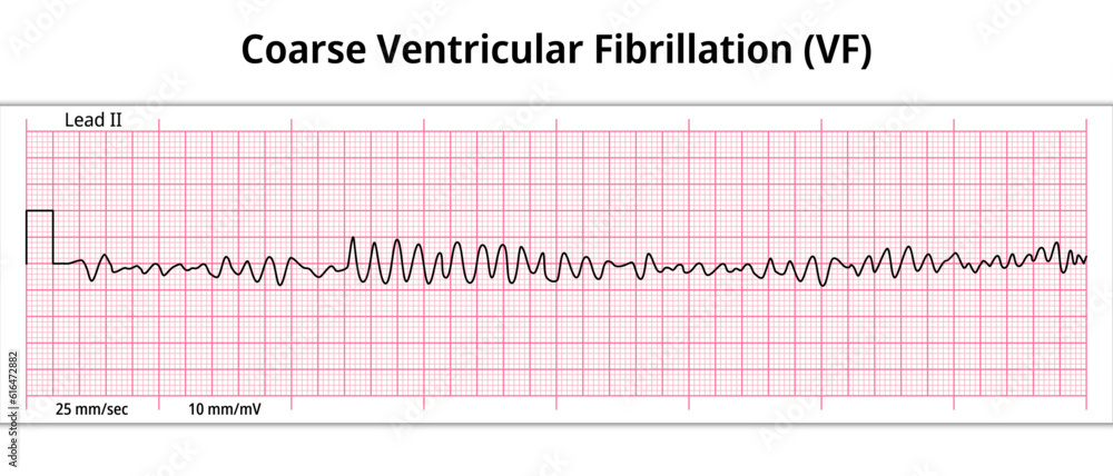 ECG Coarse Ventricular Fibrillation - 8 Second ECG Paper - Electrocardiography Medical Vector ...
