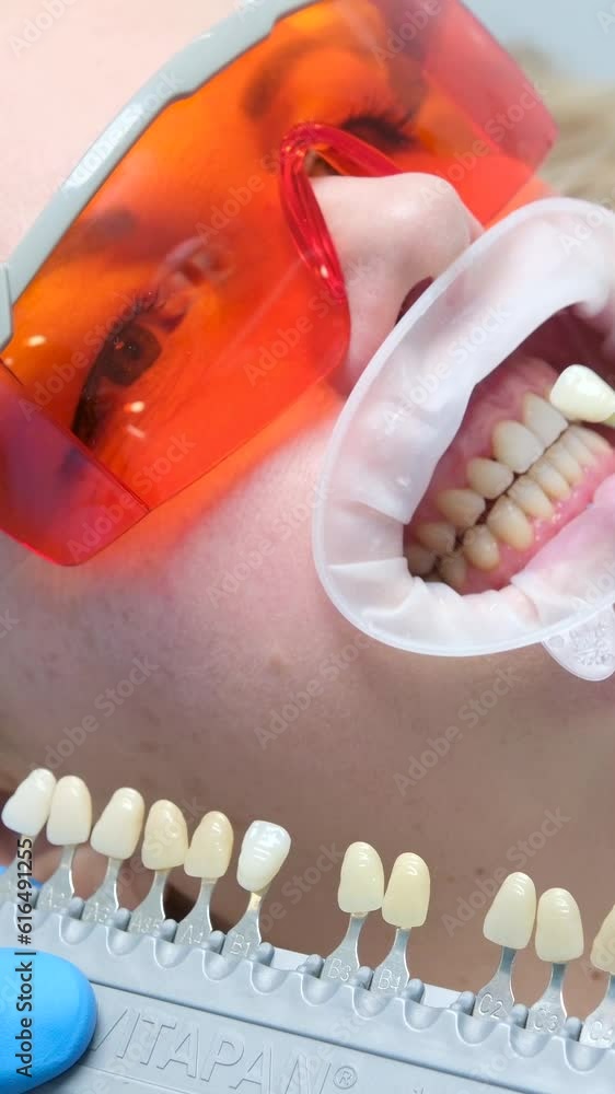 classical dental coloring for determining color of teeth Banner tooth ...