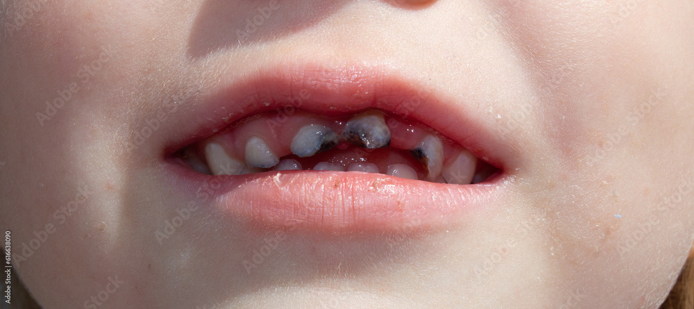 Rotten milk teeth in a child close-up. Milk teeth with caries in a ...