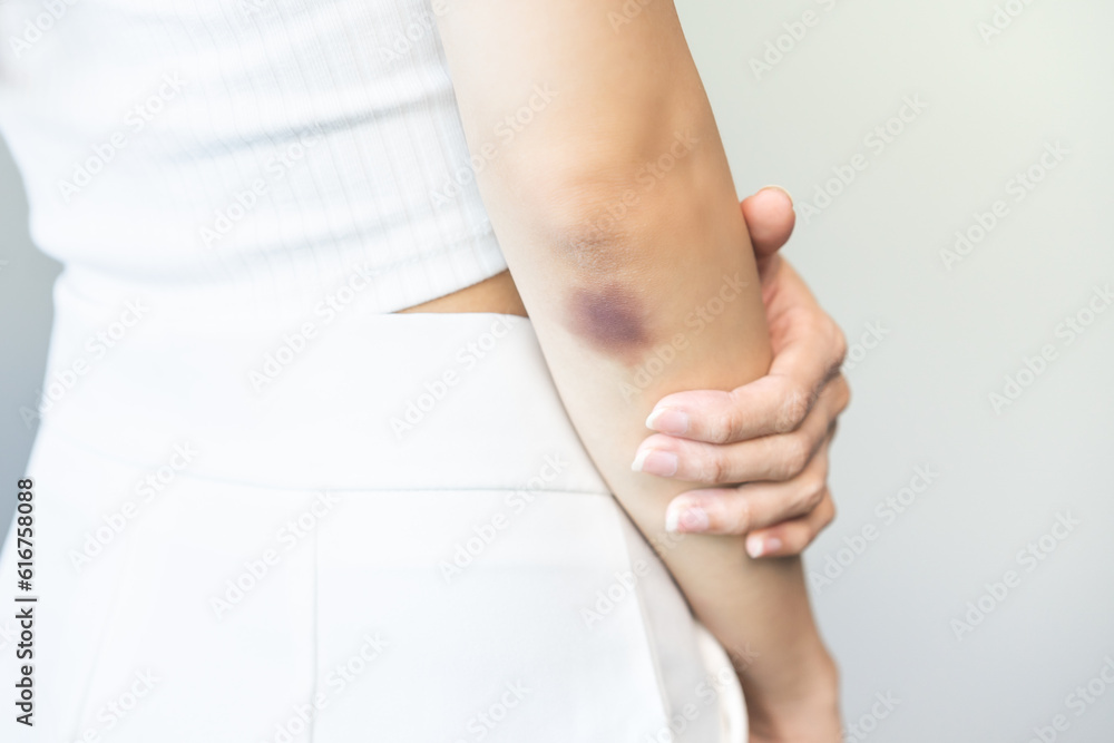 Close up of stain bruise wound on arm, contusion asian young woman ...