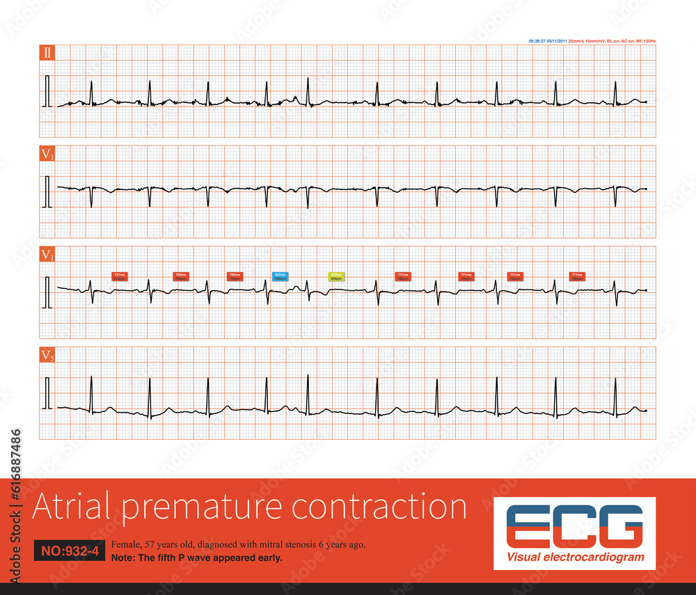 Poster A 57-year-old female patient with mitral stenosis had an ...