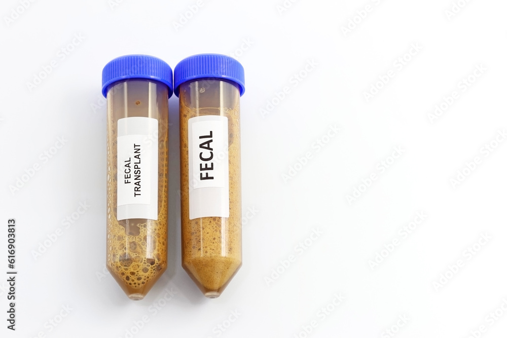 Fecal transplant or fecal matter transplant (FMT). Laboratory tubes ...