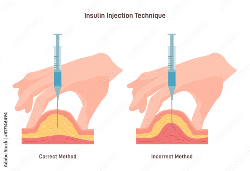 Insulin Injection Technique Correct And Incorrect Way Cross Section Stock Vector Adobe Stock