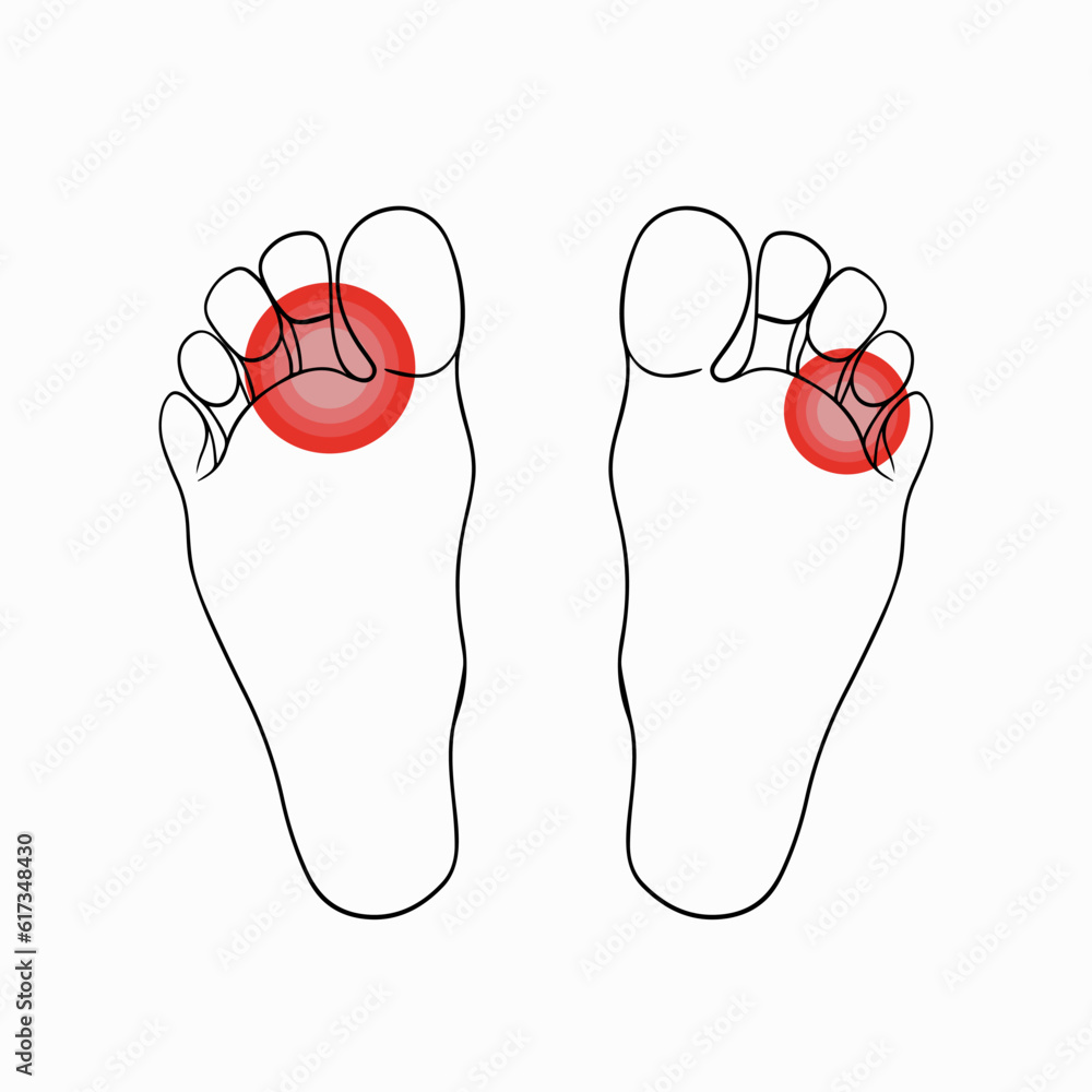 Vector isolated illustration of foot fungus. Contour drawing of foot ...
