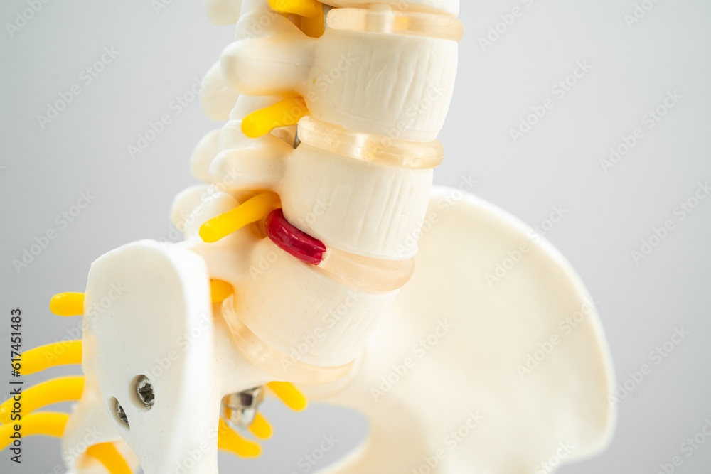 Lumbar spine displaced herniated disc fragment, spinal nerve and bone ...