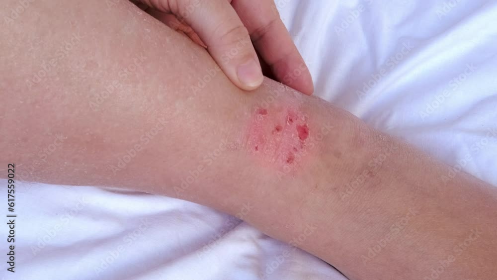 person scratches psoriatic rashes on skin with hand with chronic ...