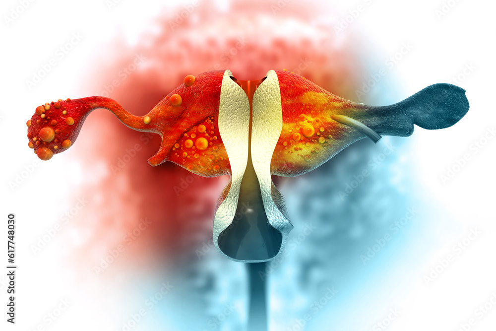 Photo & Art Print Female reproductive system diseases, Crystal light