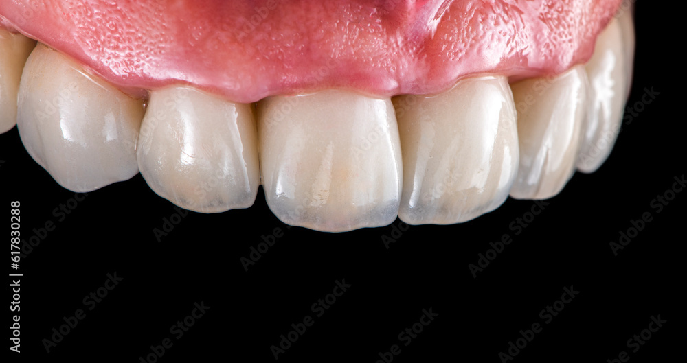 emax crowns on teeth and implants Stock Photo | Adobe Stock