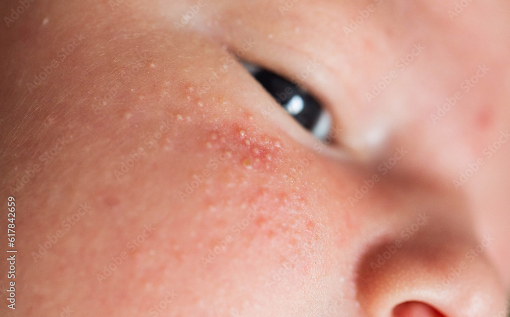 Rash on the face of a newborn baby. The process of formation of the ...