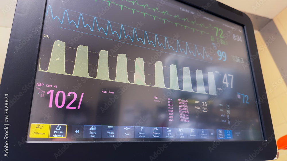 Medical vital signs monitor displaying critical health metrics - blood ...