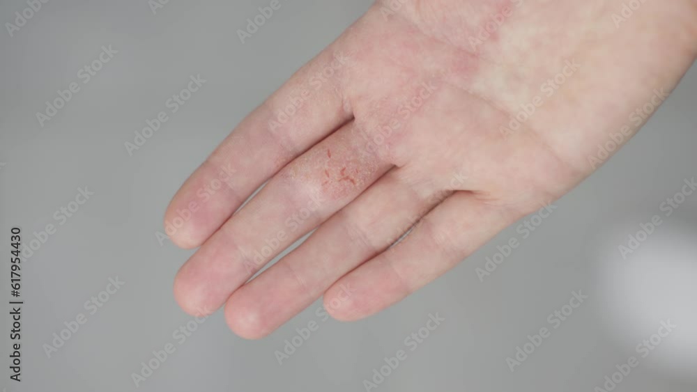Dermatitis Hands Palm Skin Itchy Scratches On Dry Skin Female Hands