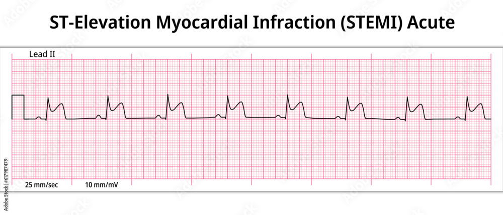 ST-Elevation Myocardial Infarction (STEMI) Acute - 8 Second ECG Paper - Electrocardiography ...