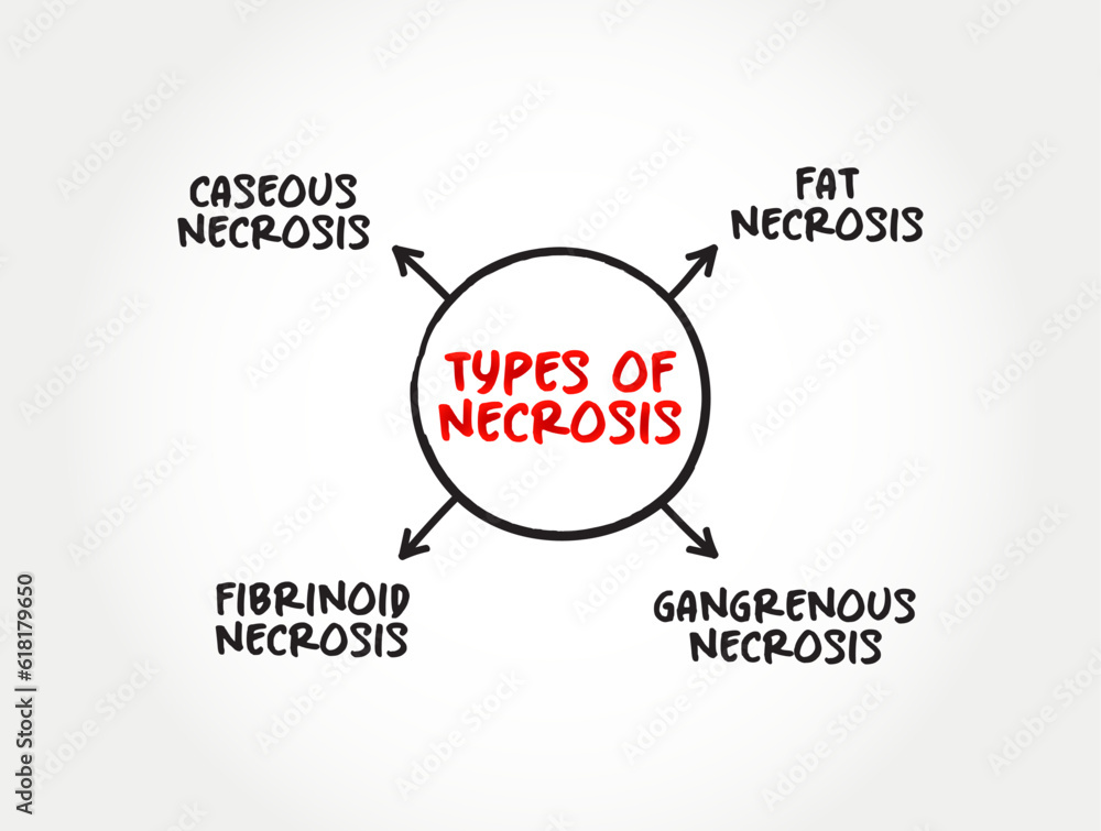 Types of Necrosis (death of body tissue) mind map text concept for ...