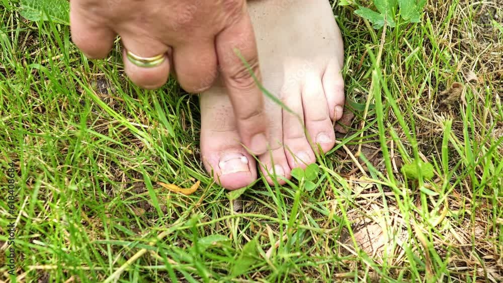 Hardware medical pedicure. Podology. Correction of the shape of the ...