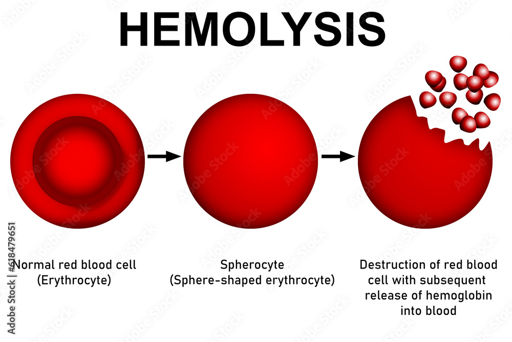 Scientific diagram and process of hemolysis Stock Photo | Adobe Stock