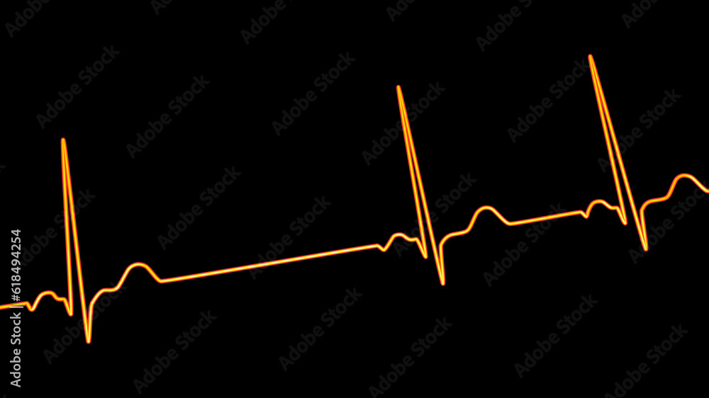 Electrocardiogram ECG displaying sinus arrhythmia, 3D illustration ...