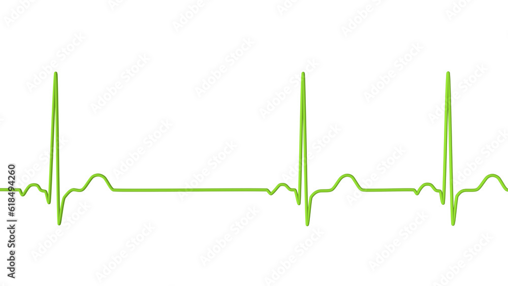 Electrocardiogram ECG displaying sinus arrhythmia, 3D illustration ...