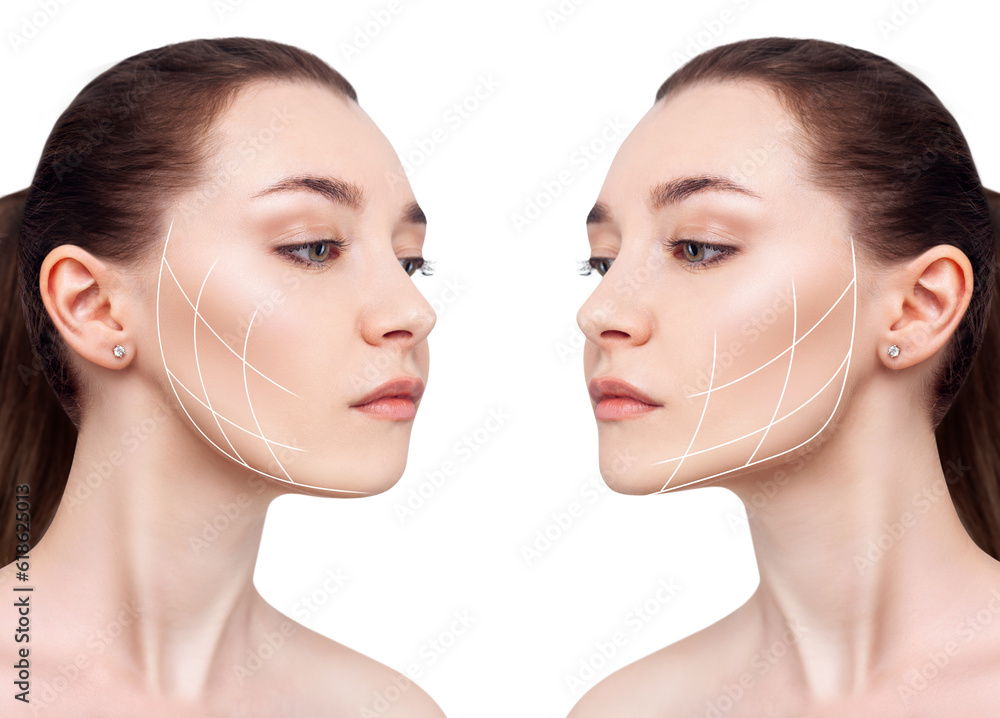 Woman before and after cheekbones shape correction. Stock Photo | Adobe ...