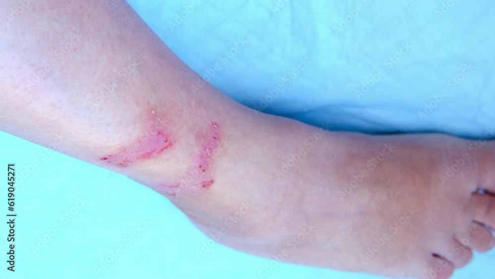 close-up of human shin, numerous wounds on leg of adult female patient ...