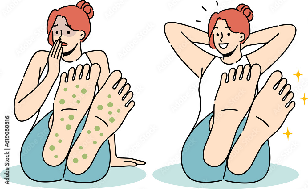 Woman with rash on feet suffers from allergies and fungal infection ...