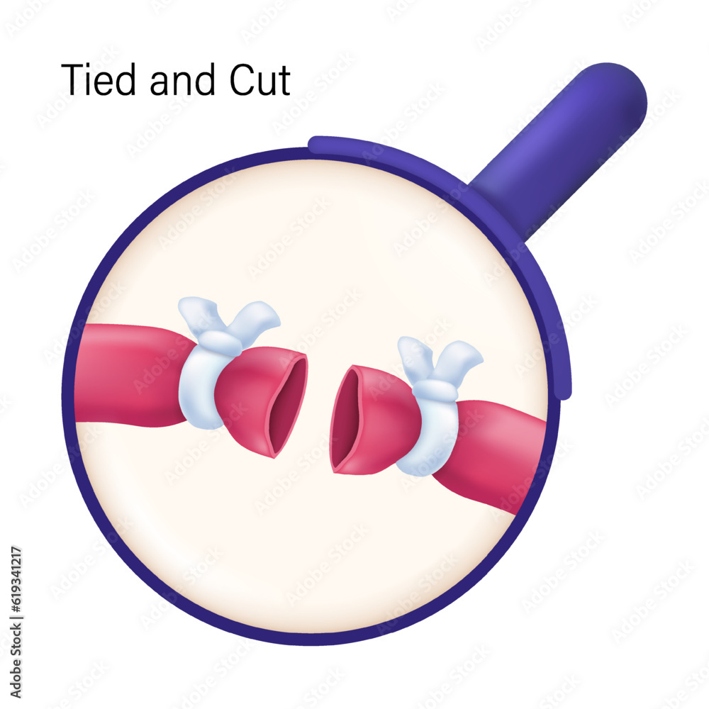 Vetor de Tied and cut method of female sterilization. Tubal ligation ...