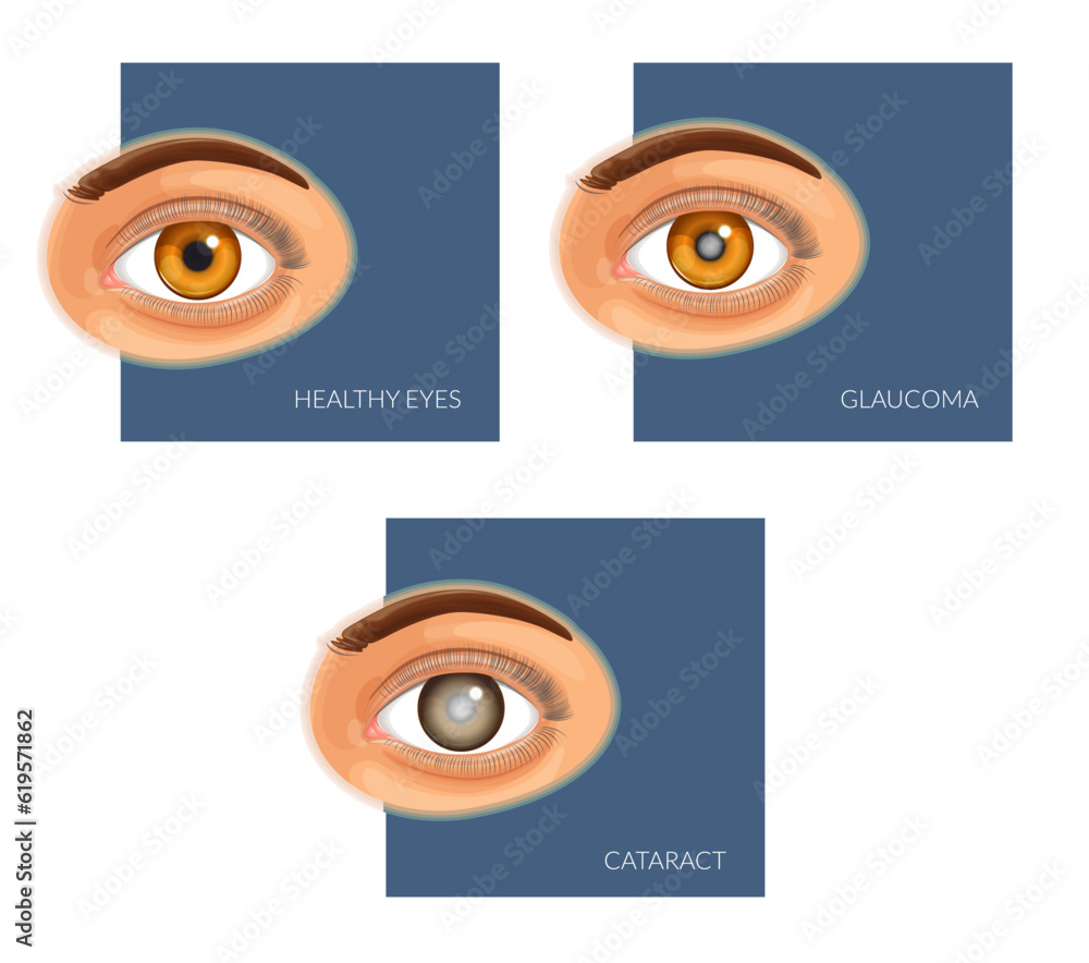 Human Healthy Eye and Eye with Cataract and Glaucoma- Illustration ...