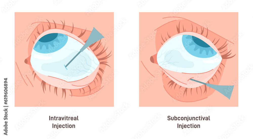 Eyes injection types. Intravitreal and subconjunctival injection ...