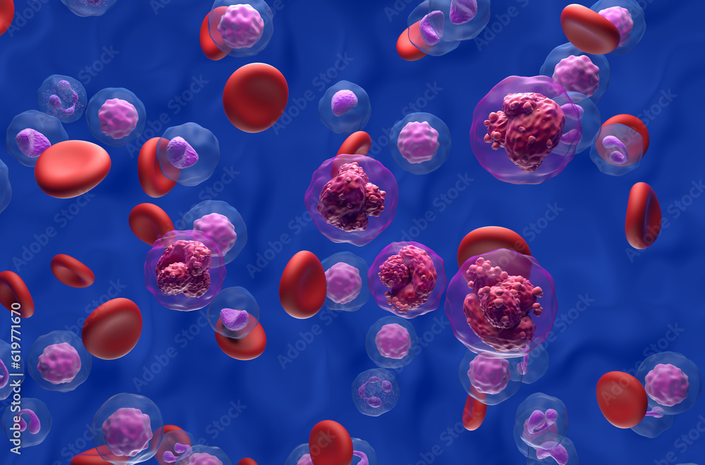 Acute lymphoblastic leukemia (ALL) cancer cells in the blood flow ...
