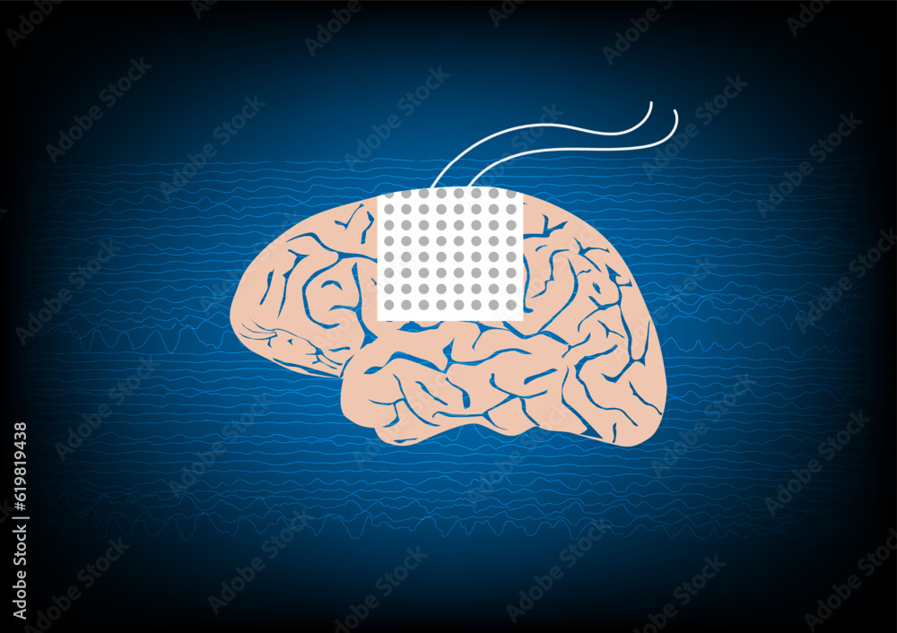 Illustration of subdural electrode over brain surface for EEG or brain ...