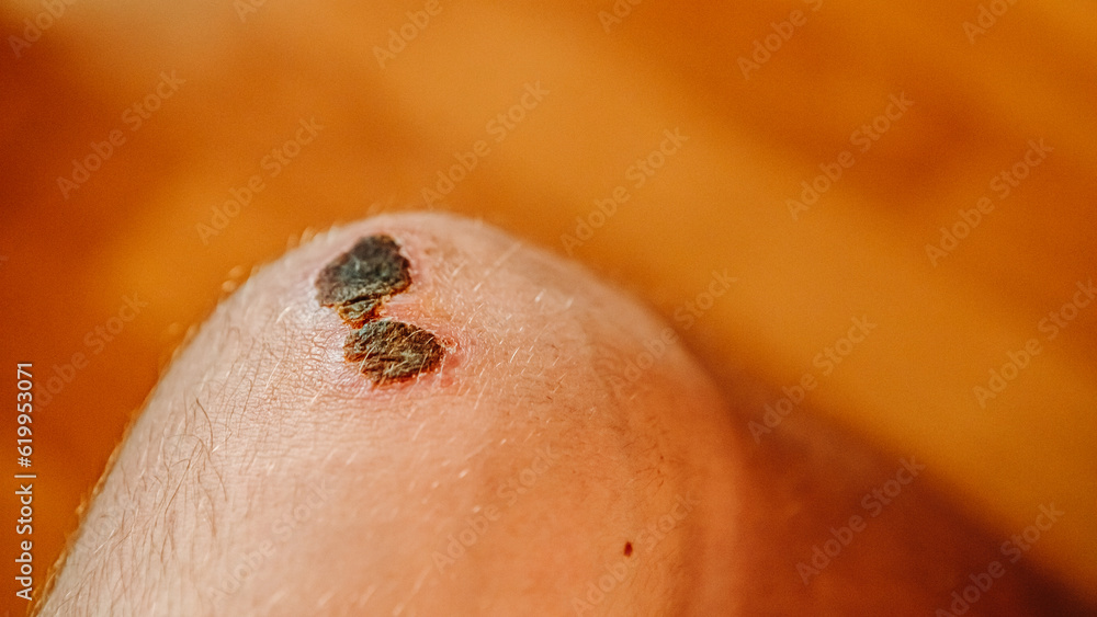 Close up bleeding scratches knees, bruises on the skin, close up injury ...
