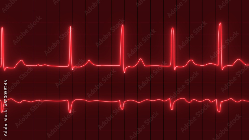 ECG with supraventricular premature beats and short paroxysms of neon ...