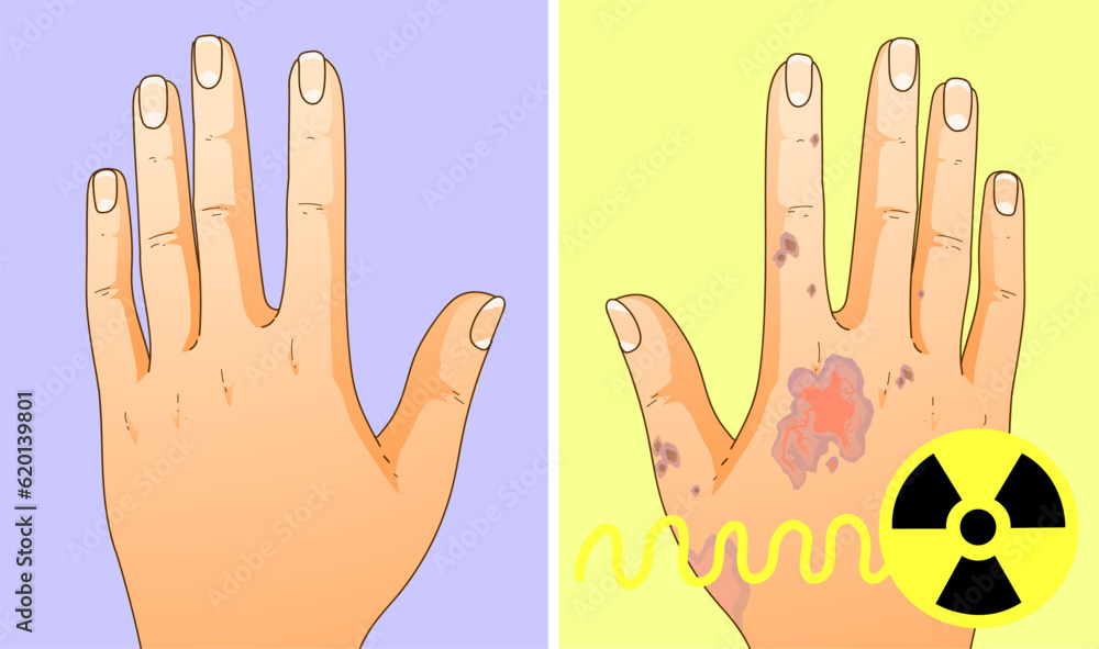 Effects of radiation on human health. Skin lesion. Healthcare ...