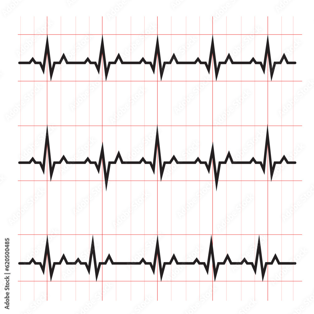 Normal and abnormal ECG cardiogram diagram schematic vector ...