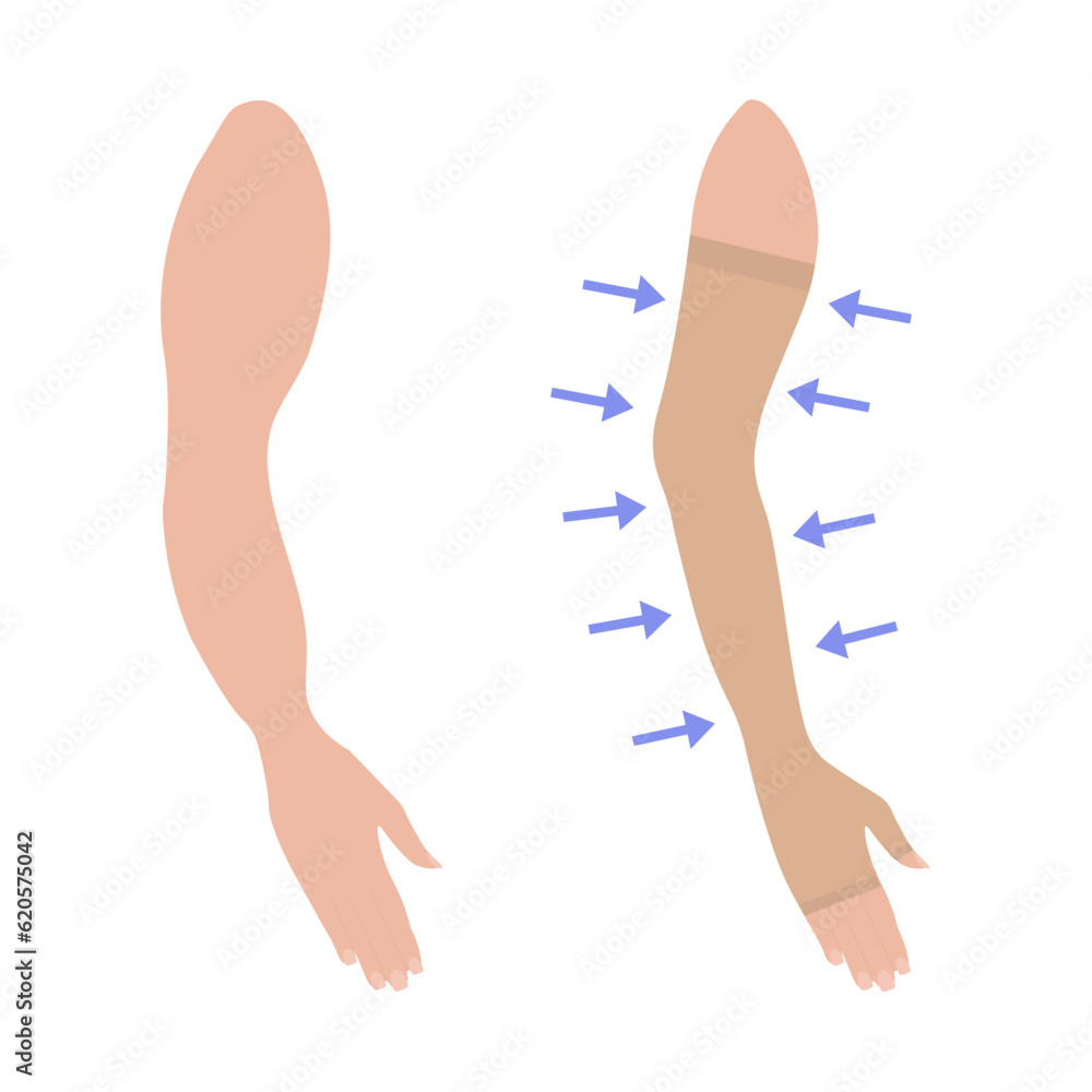 Lymphedema. Female arm in Compression Sleeve with finger. Woman's hand ...