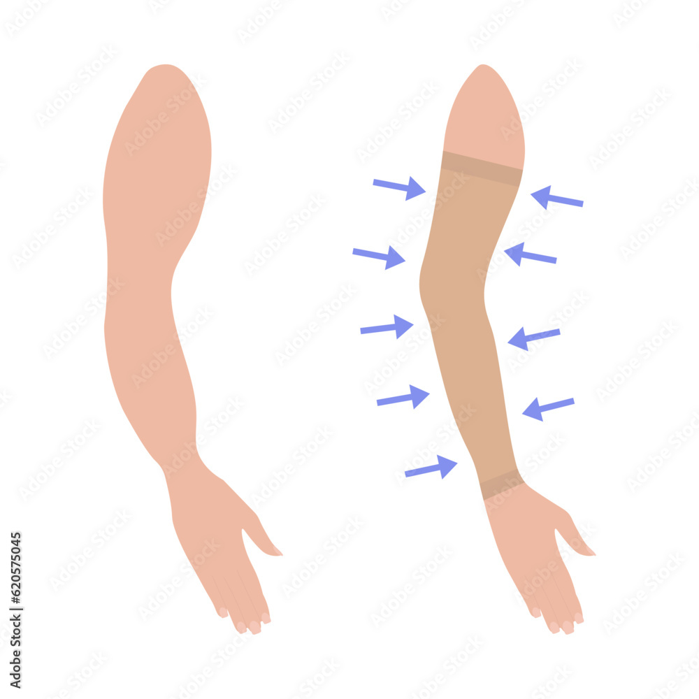 Lymphedema. Female arm in Compression Sleeve. Woman's hand. Swelling ...