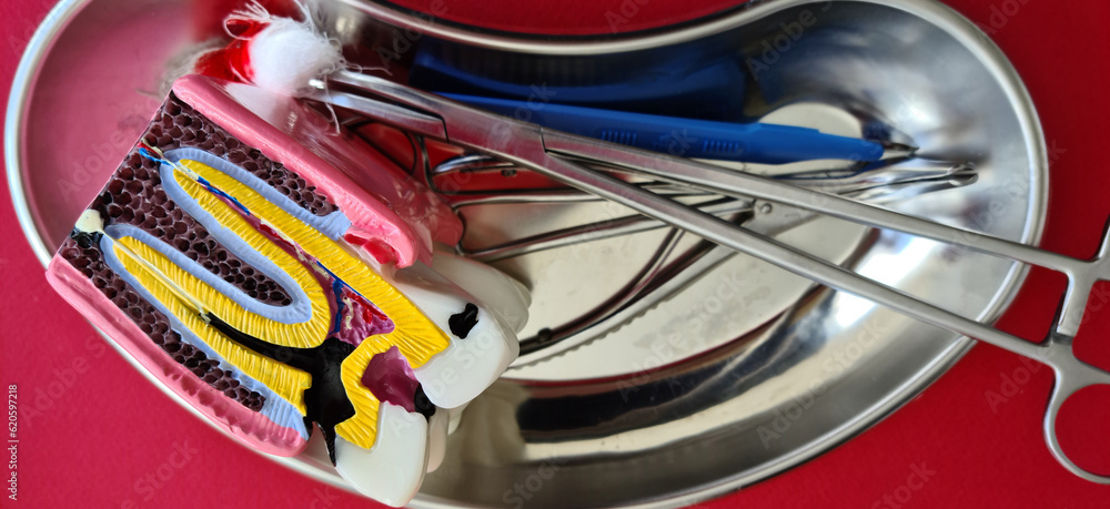 Extracted tooth with caries anatomy. Treatment and extraction of teeth ...