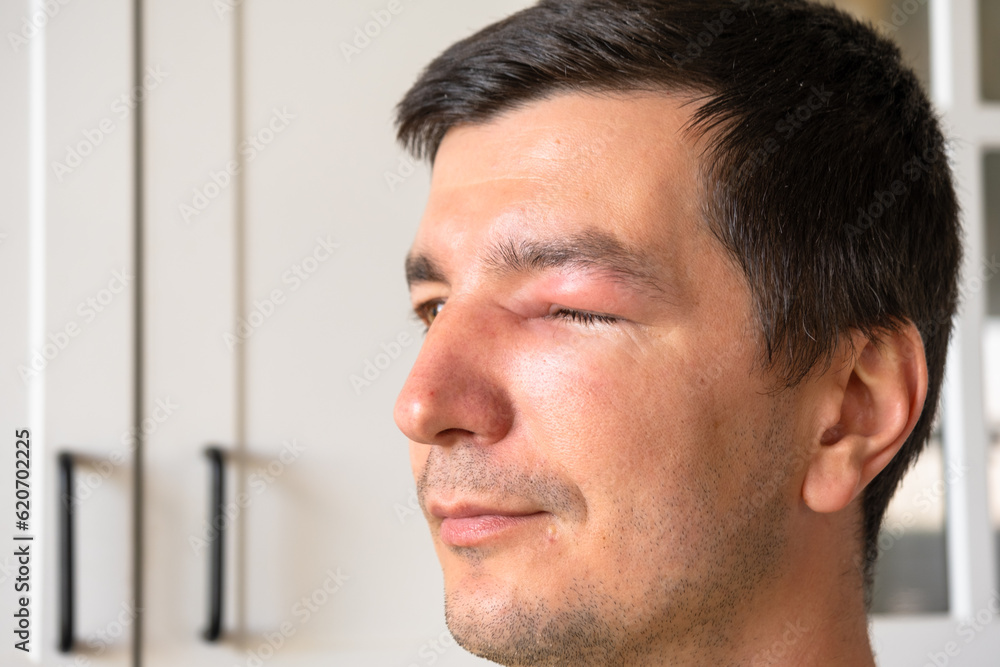 A red swollen eyelid on a man's face in close-up is an allergy to an ...