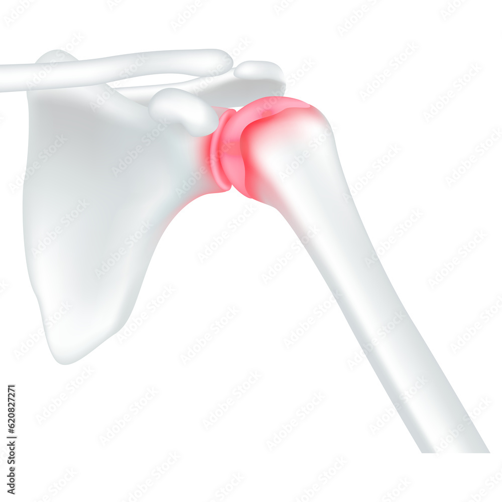 Shoulder bone pain and joint arthritis cartilage front becomes worn ...